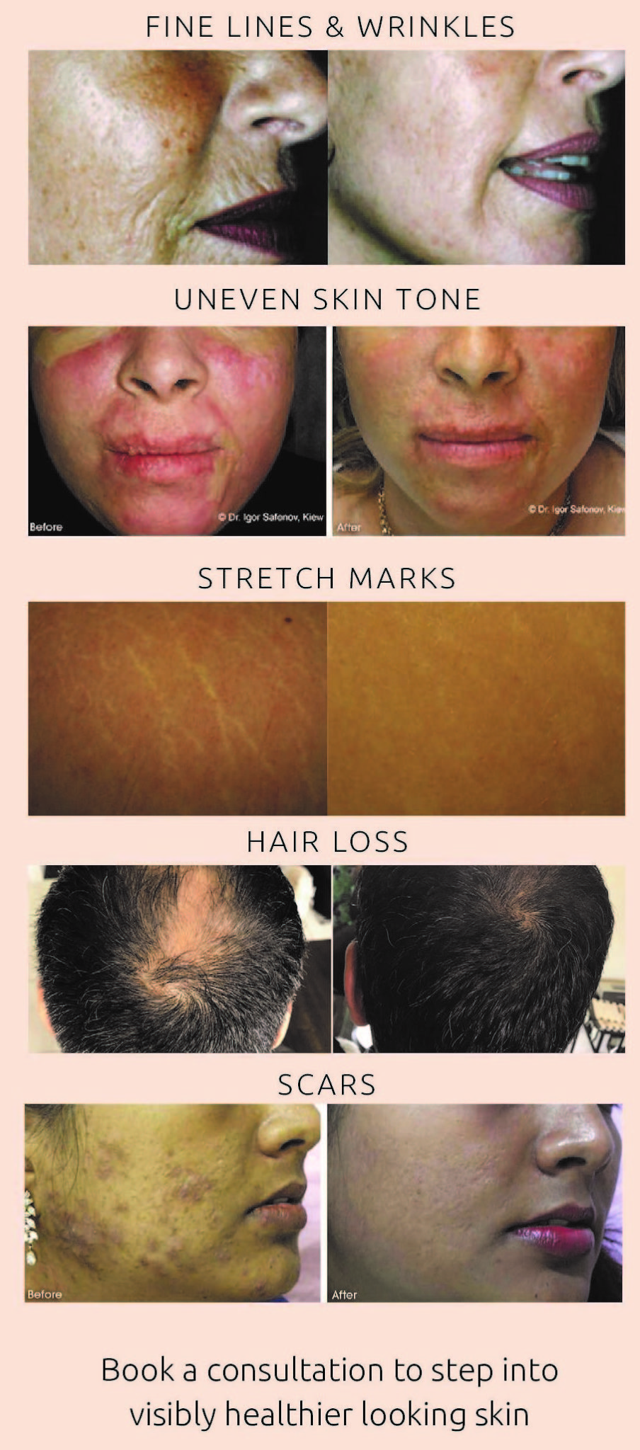 Microneedling - Atlantic Beauty